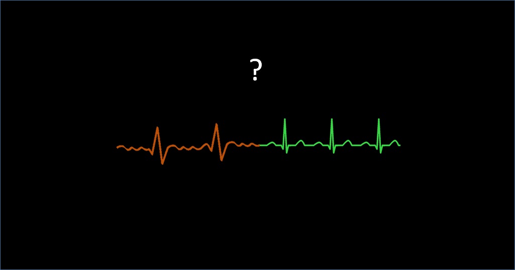 How I stopped my AFib Episodes the first time – Get rid of AFib Blog